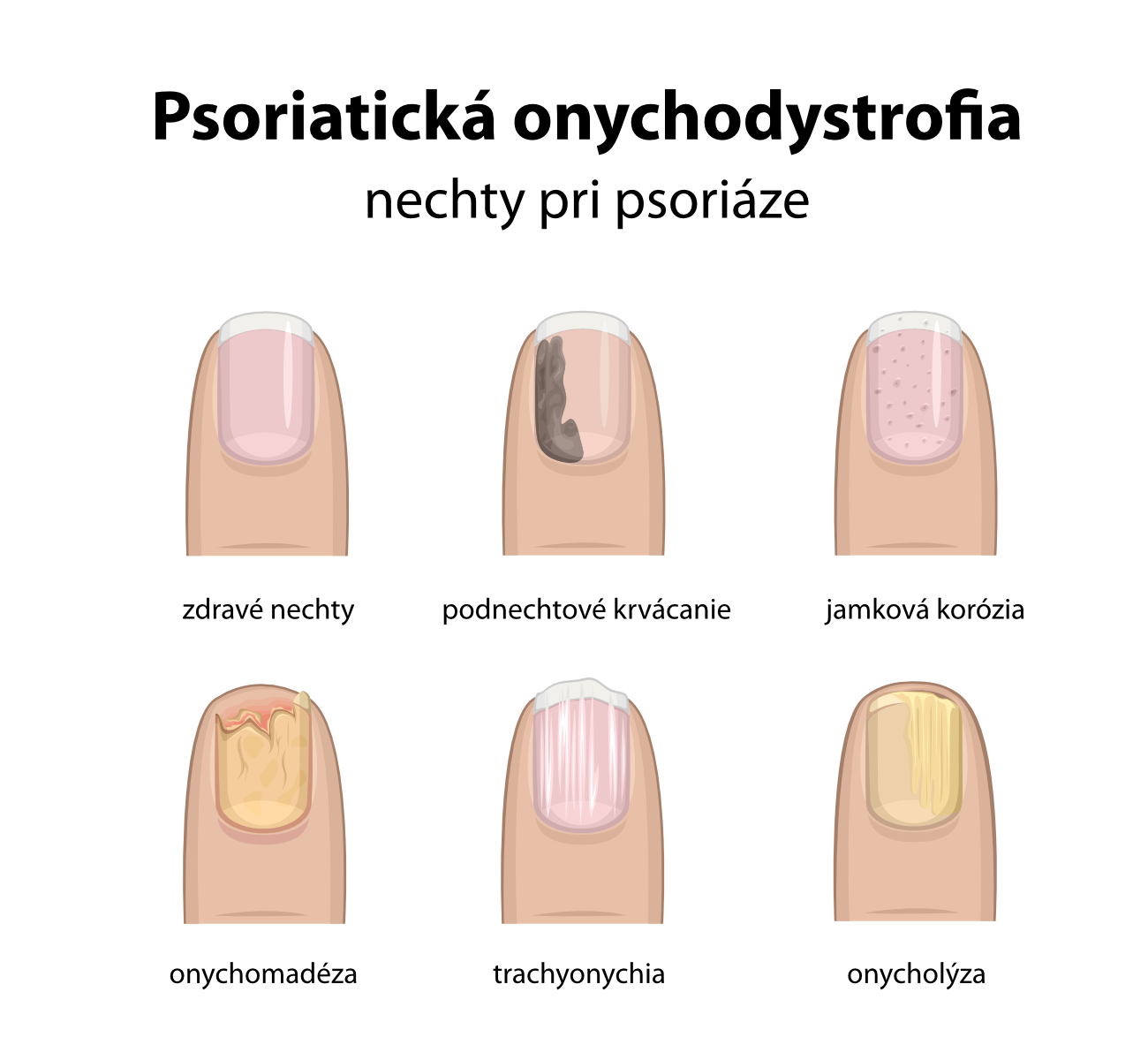 Formy psoriázy a možnosti jej diagnostikovania - Slovenský pacient