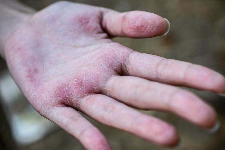 Seboroická dermatitída: príčina, prejavy, liečba - Slovenský pacient